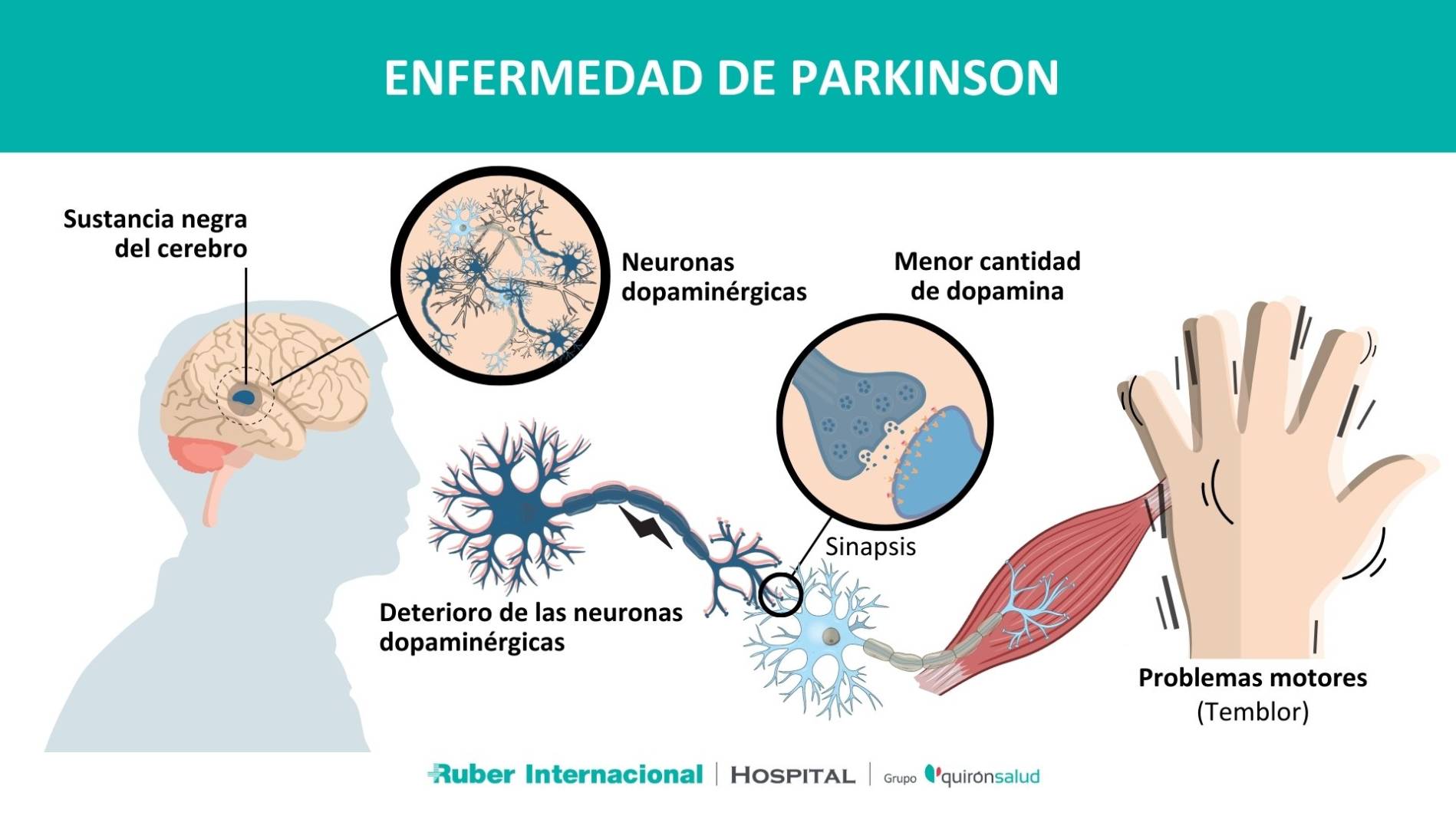¿Qué es la enfermedad de Parkinson?